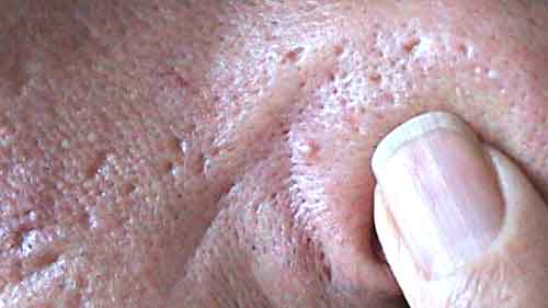 Skin conditions and disorders caused by fold crossings